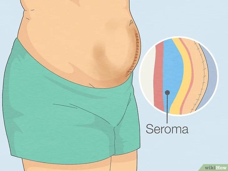 Seroma Fluid Removal STL Post Op Care